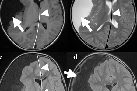Brazilian Journal of Neurosurgery - JBNC
